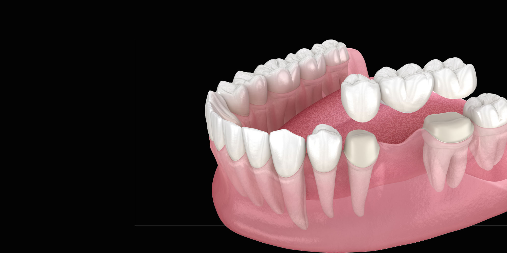 Dental Bridge in Long Island, NY | Huntington & Rocky Point